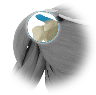 Clinique Chirurgicale de Laval | Shoulder | Arthroscopic acromioplasty