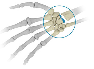 Clinique Chirurgicale de Laval | Wrist Hand | Arthroplasty osteotomy ...